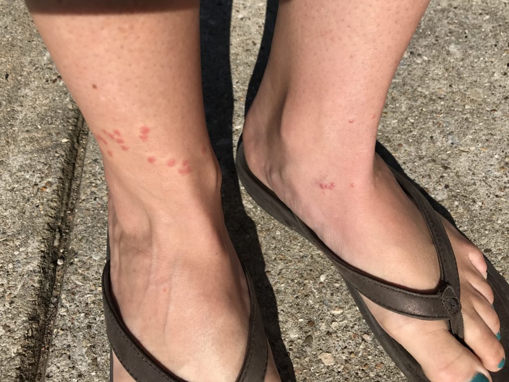 What to do when the bed bugs bite – Journey Monkeys